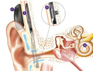 FDA Clears New Hearing Implant System From Cochlear - Magnetics Magazine