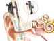 FDA Clears New Hearing Implant System From Cochlear - Magnetics Magazine